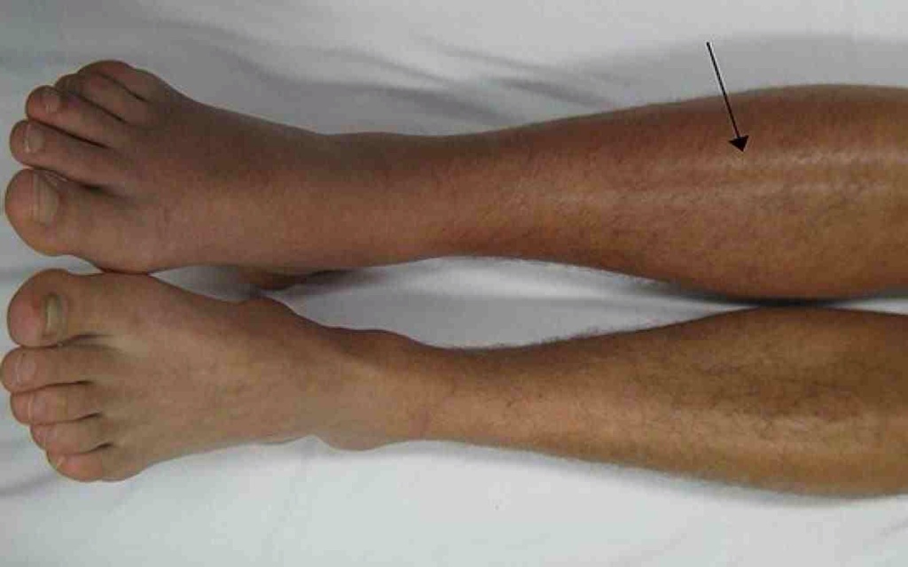 Calf Tears Swelling And DVT RunningPhysio Calf Tears Swelling And DVT RunningPhysio