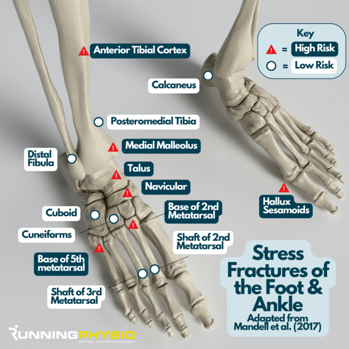Stress fractures of the foot & ankle [infographic] - RunningPhysio