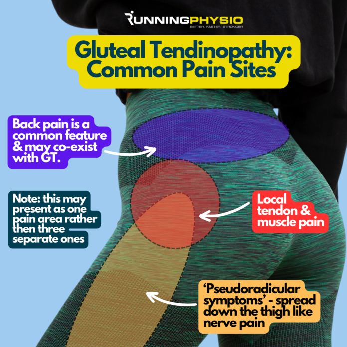 Proximal ITBS: Symptoms & Solutions - RunningPhysio